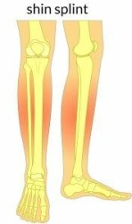 Alles over Shin Splints- oorzaak en behandeling