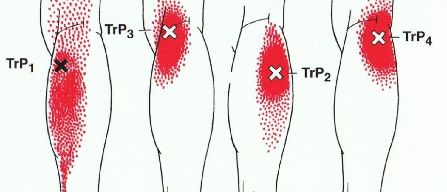Alles over SI-gewrichtspijn- oorzaken en behandeling