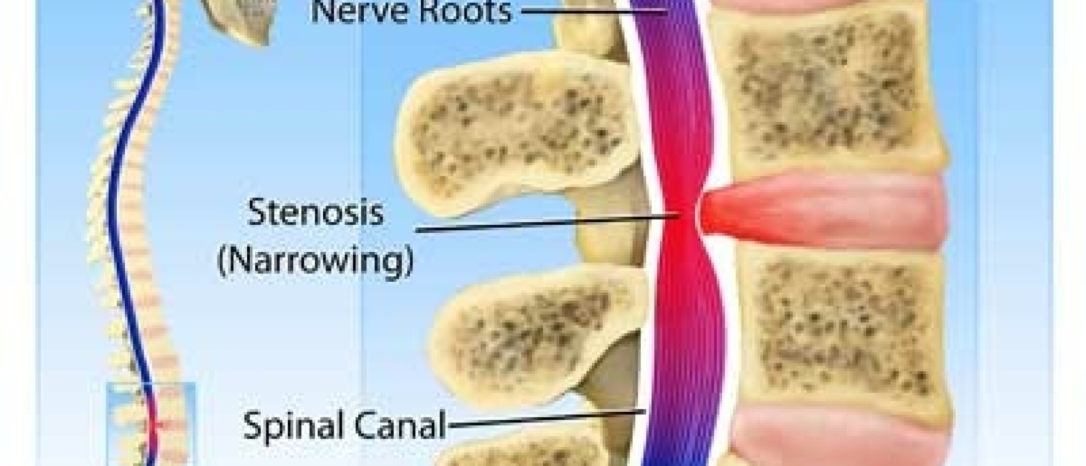 Alles over Stenose in de nek- symptomen en behandeling