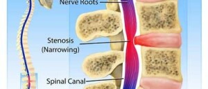 Alles over Stenose in de nek- symptomen en behandeling