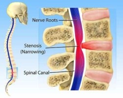 Alles over Stenose in de rug- oorzaak en behandeling
