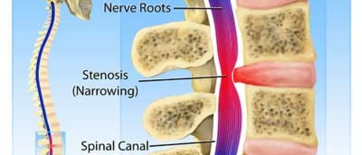 Alles over Stenose in de nek- symptomen en behandeling
