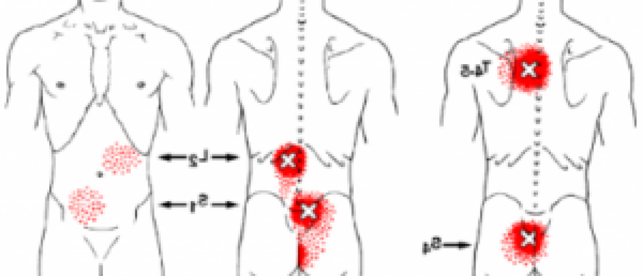 Alles over Spondylolisthesis- symptomen en behandeling