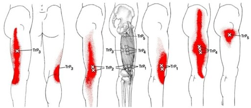 Beknelde zenuw in de nek, Oorzaak & Behandeling