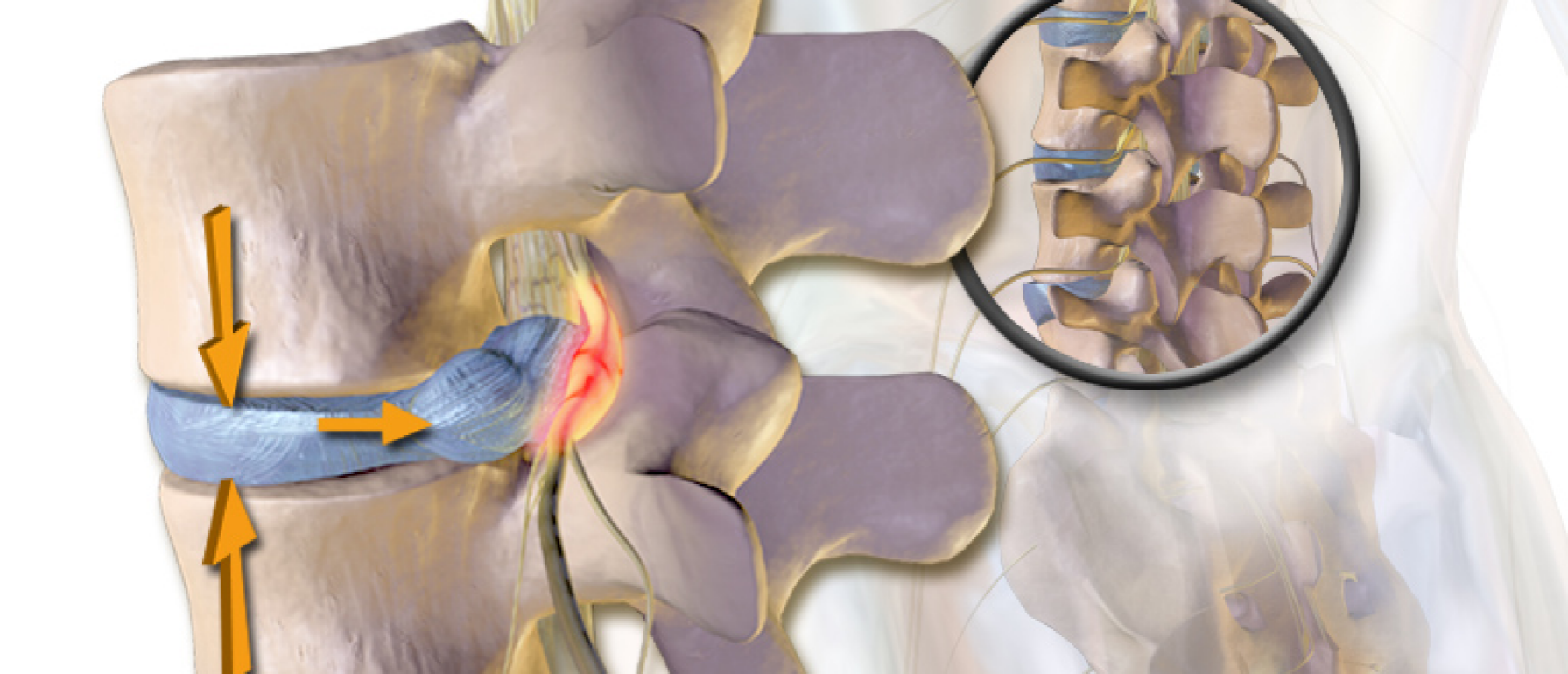 Acute hernia - oorzaak, symptomen en behandeling