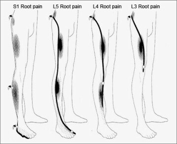 Alles over hernia L4-L5- symptomen en behandeling