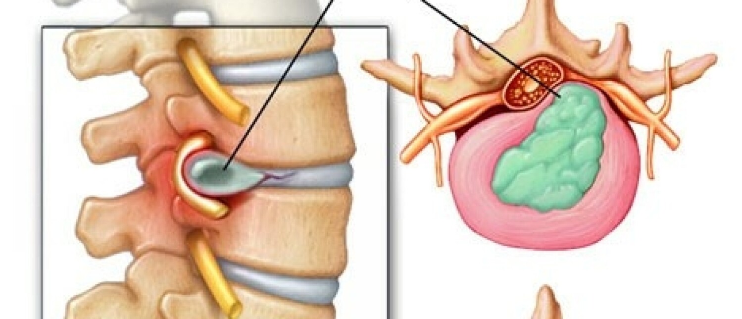 Acute hernia - oorzaak, symptomen en behandeling