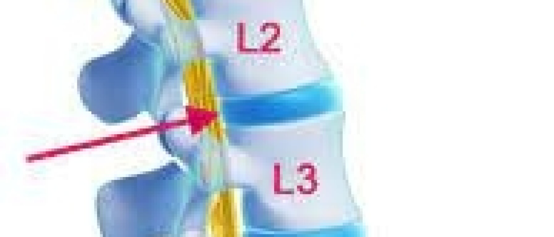 Alles over Discopathie- symptomen en behandeling