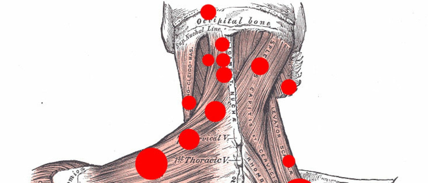 Chronische triggerpoints: hoe kom je er vanaf?