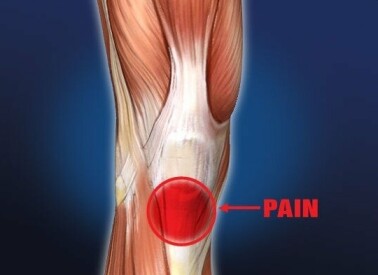Kniepijnvrij: De 5 meest voorkomende overbelastingsblessures van de knie