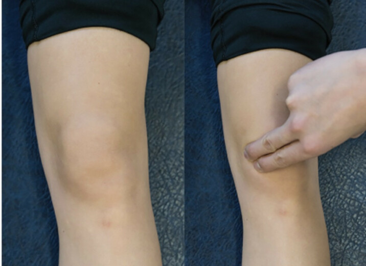 Kniepijnvrij - Het plica syndroom