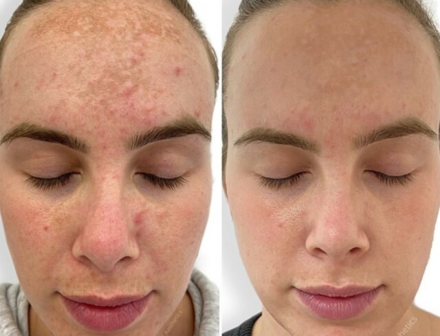 Lumecca | Krachtigste IPL behandeling op de markt | Gaaf Injectables