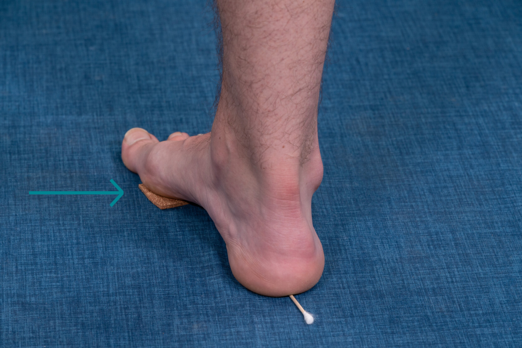 Behandeling hallux valgus na operatie