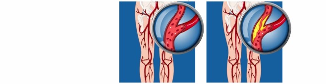 Claudicatio intermittens (PAV/etalagebenen) | Fysiotherapie-tieberink
