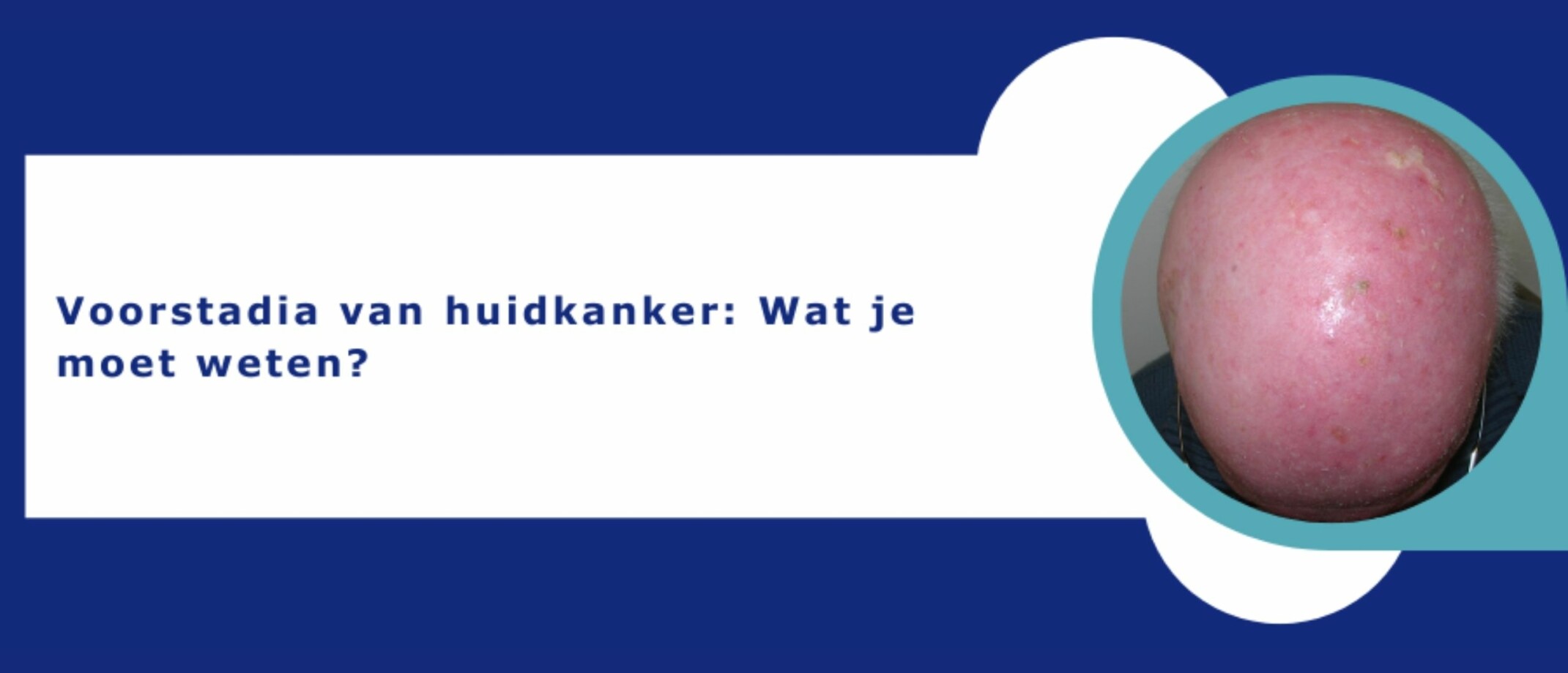 Voorstadia van huidkanker: wat je moet weten | Huidopleiding.nl