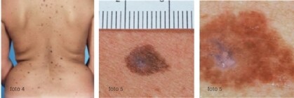 Melanoom: symptomen, risicofactoren en behandeling