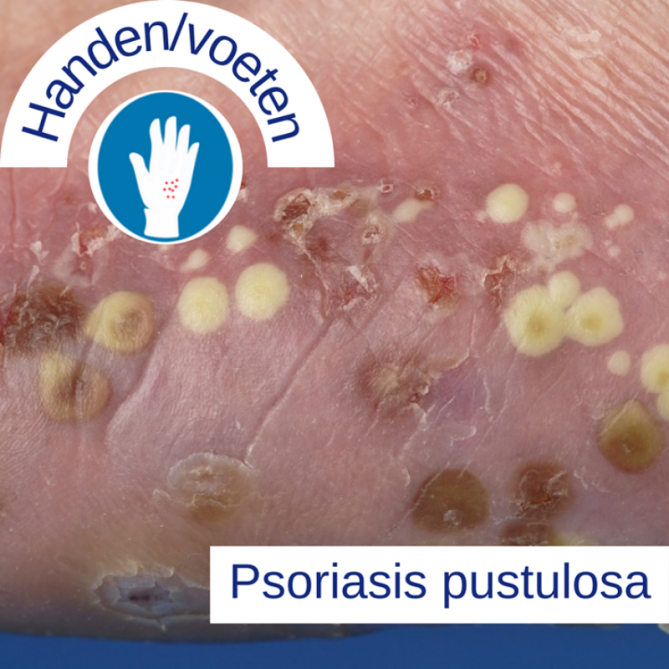 Psoriasis – Vormen en diagnose helder uitgelegd