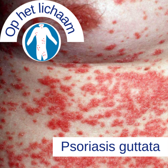 Psoriasis – Vormen en diagnose helder uitgelegd