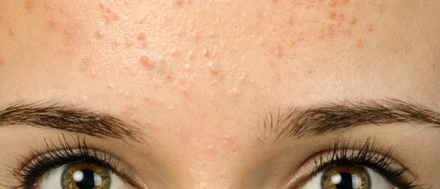 Van puistjes of acne afkomen? 7 mythes ontrafeld!