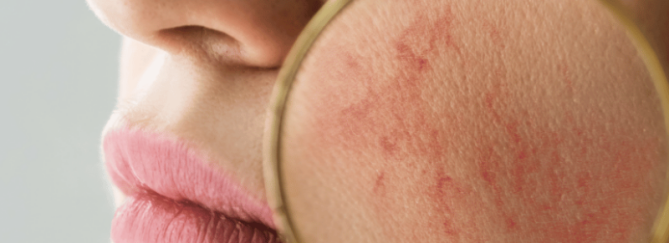 Rosacea kind | Gesprongen vaatjes | Mijn tips als huidtherapeut