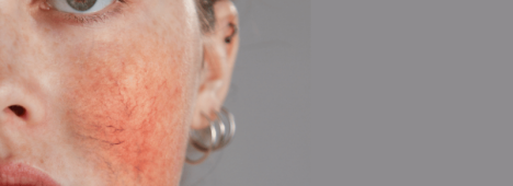Rosacea kind | Gesprongen vaatjes | Mijn tips als huidtherapeut