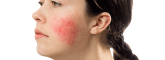 Rosacea kind | Gesprongen vaatjes | Mijn tips als huidtherapeut