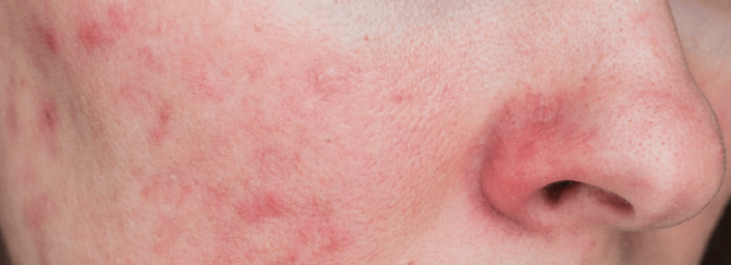 Rosacea kind | Gesprongen vaatjes | Mijn tips als huidtherapeut