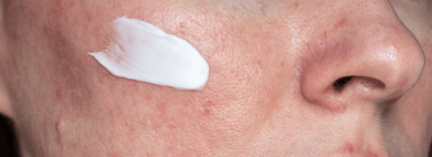 Rosacea kind | Gesprongen vaatjes | Mijn tips als huidtherapeut