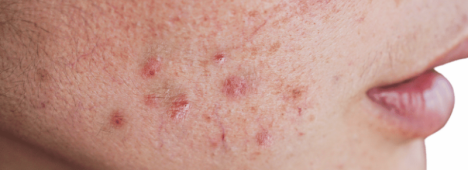 Rosacea kind | Gesprongen vaatjes | Mijn tips als huidtherapeut