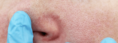 Rosacea kind | Gesprongen vaatjes | Mijn tips als huidtherapeut