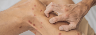 Jeukende benen | Oorzaak en tips van een huidtherapeut | Sproet