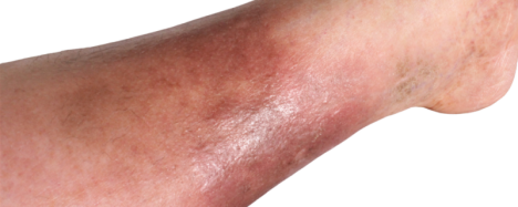 Jeukende benen | Oorzaak en tips van een huidtherapeut | Sproet