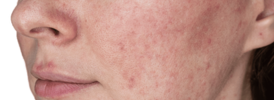Rode huid gezicht | Oorzaak en tips | Sproet