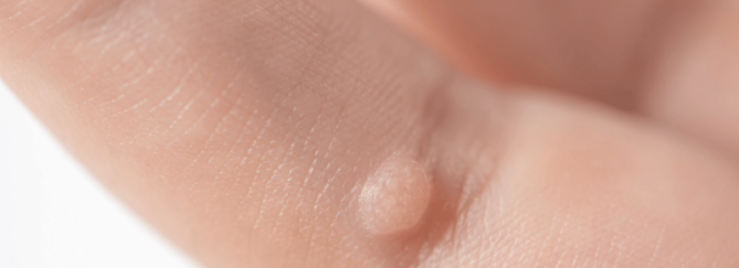 Helpt bijengif tegen wratten? | Sproet