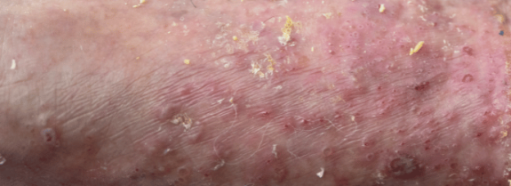 Rode plek op onderbeen | Oorzaak en oplossing | Sproet