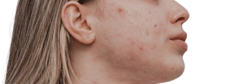 Acne bij volwassenen | Wat te doen? | Sproet