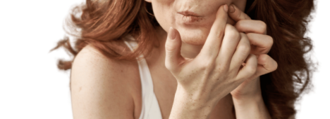 Acne bij volwassenen | Wat te doen? | Sproet