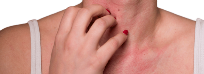 Alcohol allergie | Rode vlekken na alcohol | Wat doe je er tegen?