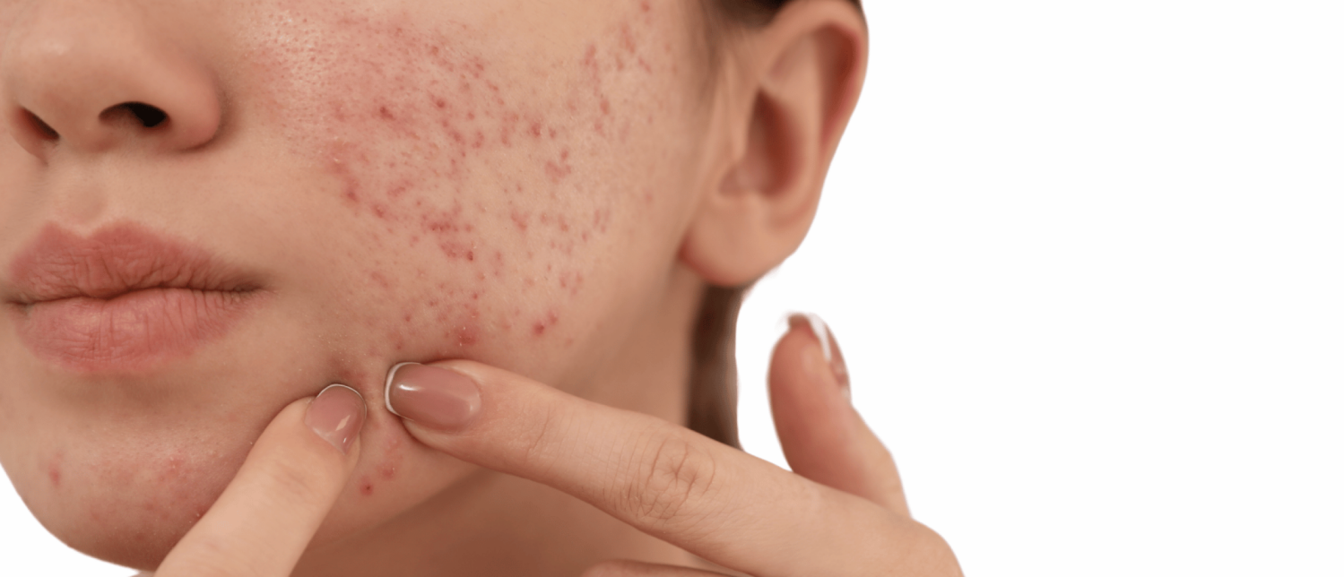 Wat helpt tegen puistjes? | Mijn tips als huidtherapeut