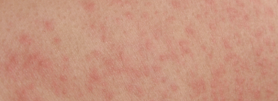 Kleine rode jeukende bultjes | Waar heb ik last van? En wat kan ik er ...