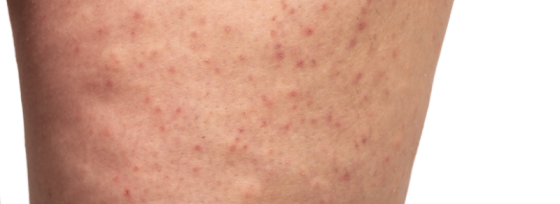 Kleine rode jeukende bultjes | Waar heb ik last van? En wat kan ik er ...