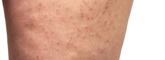 Kleine rode jeukende bultjes | Waar heb ik last van? En wat kan ik er ...