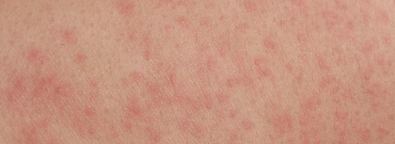 Kleine rode jeukende bultjes | Waar heb ik last van? En wat kan ik er ...