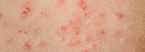 Kleine rode jeukende bultjes | Waar heb ik last van? En wat kan ik er ...