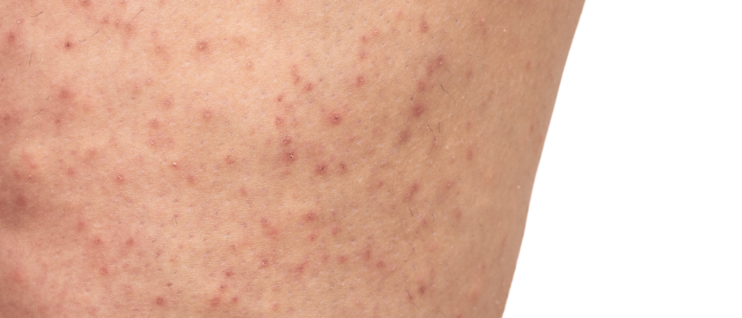 Kleine rode jeukende bultjes | Waar heb ik last van? En wat kan ik er ...