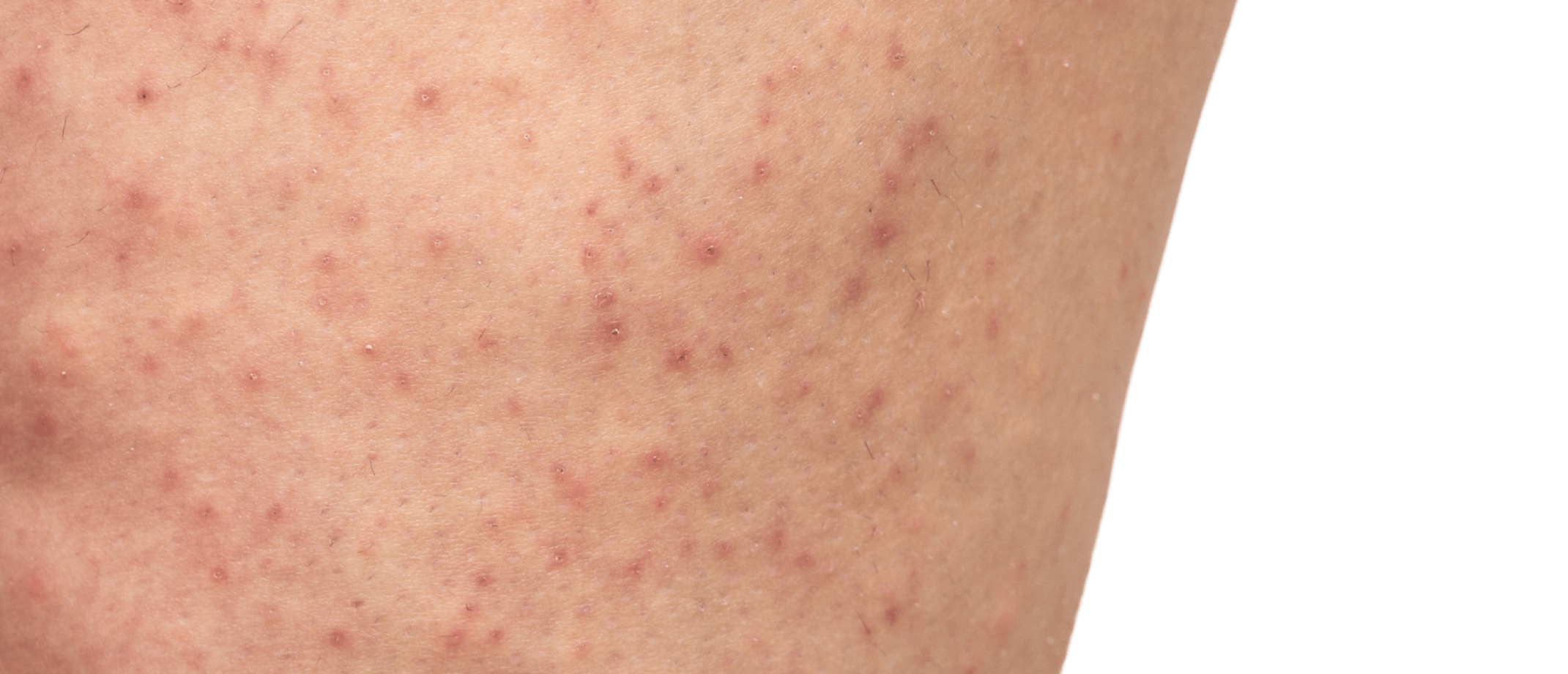 Kleine rode jeukende bultjes | Waar heb ik last van? En wat kan ik er ...