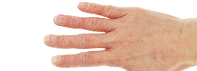 Blaasjeseczeem vingers | Wat helpt snel? | Mijn tips als huidtherapeut!