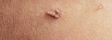 Steelwratjes verwijderen met Sudocrem | Zin of onzin?