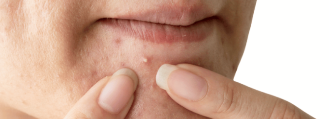 Puistjes op je kin | Hoe kom je er snel weer vanaf? | Lees hier mijn tips!