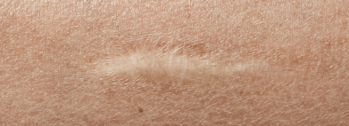 Naevus sebaceus | Bultje op het hoofd tussen het haar